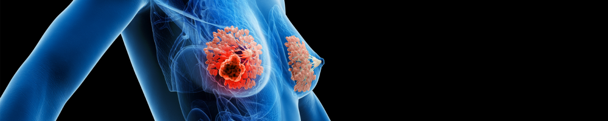 Borstkanker: vroeger opsporen door DNA-onderzoek plasma | Radboud Oncologie Fonds